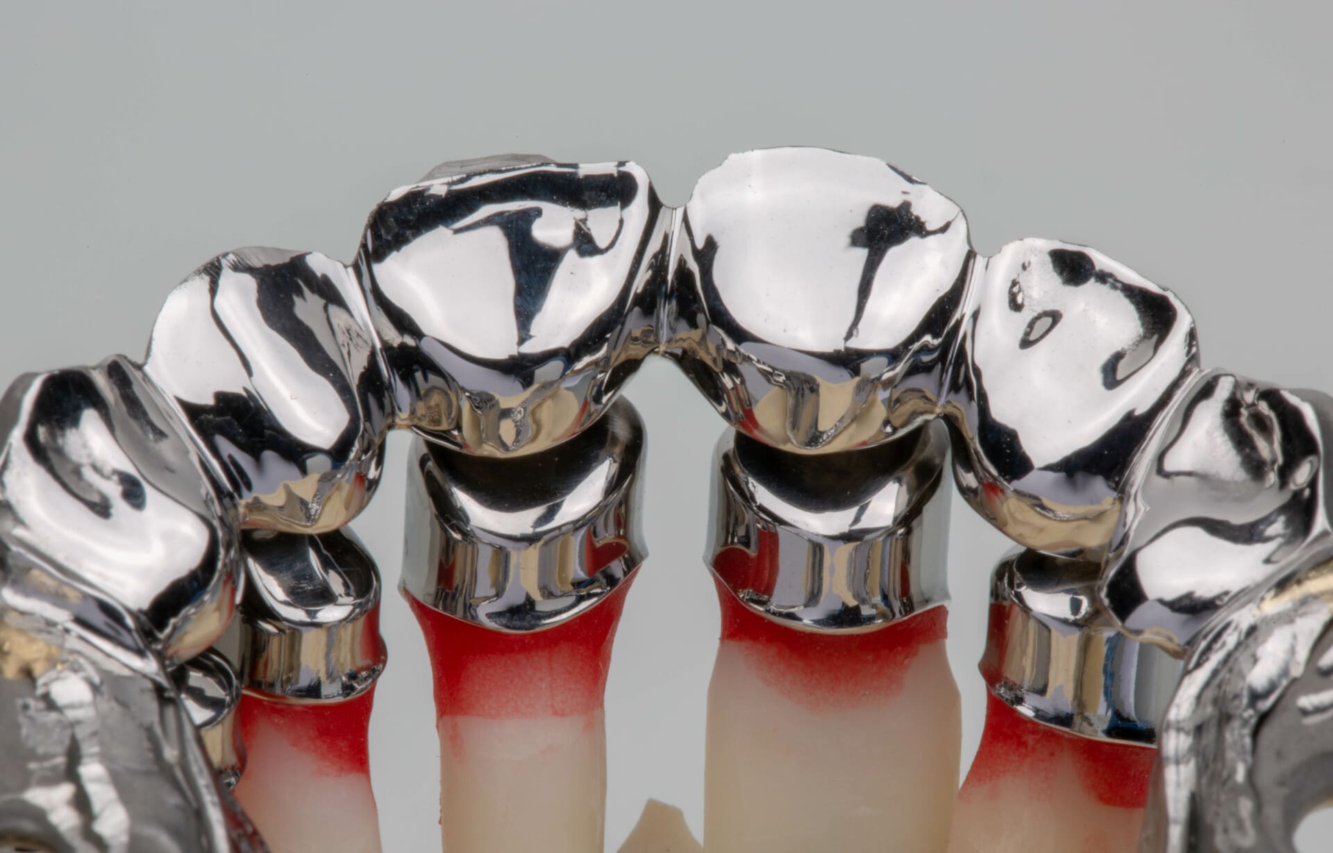 Telescoopkronen in het front - telescoopkroon-Wordpress