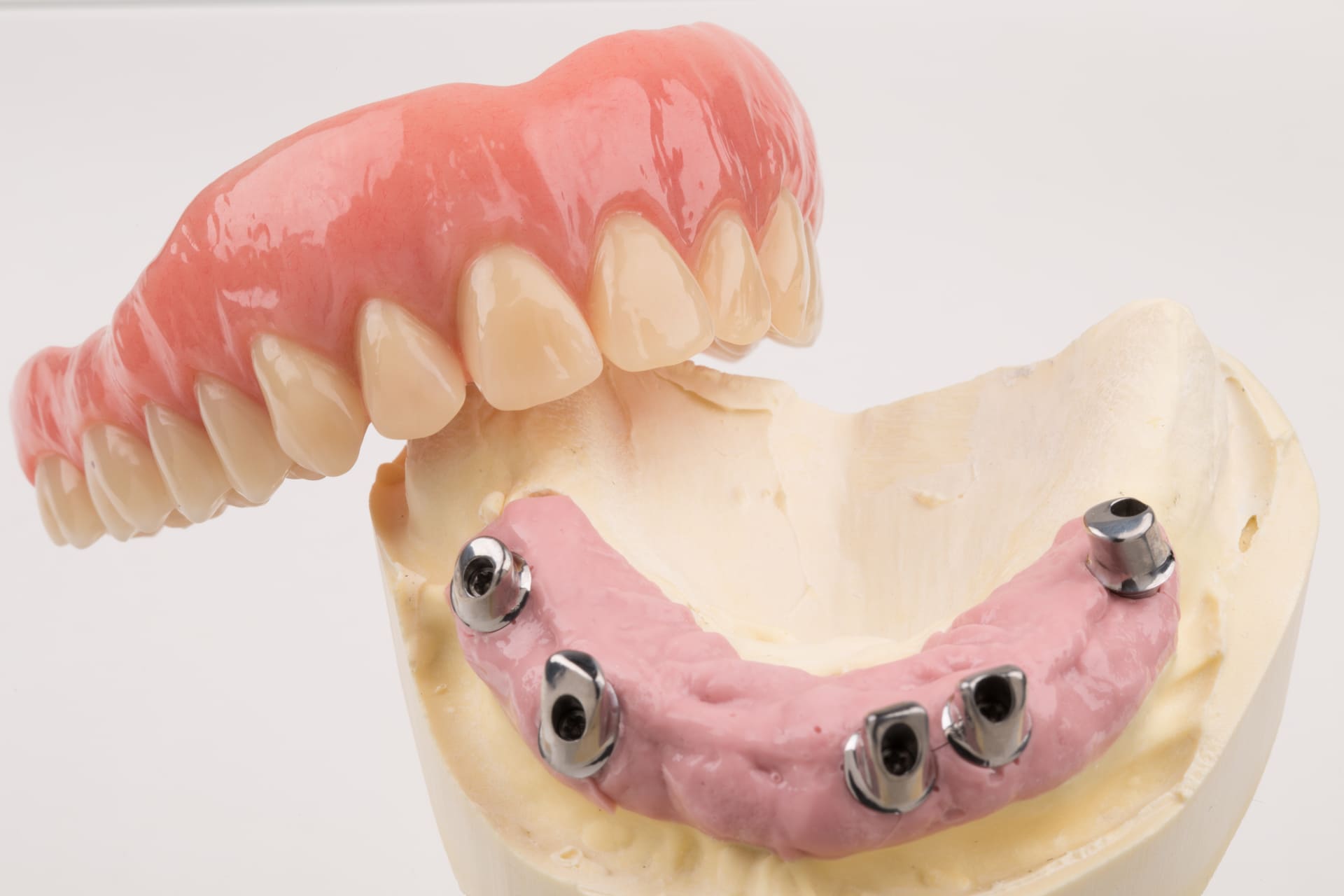 Telescoopprothese op divergerende implantaten - telescoopkroon-Wordpress