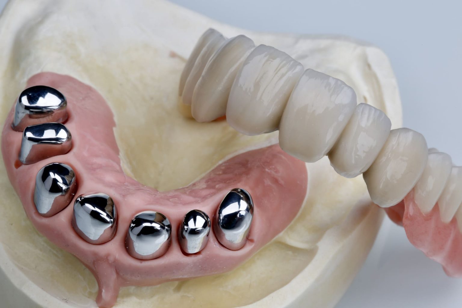 Telescoopprothese in de bovenkaak - telescoopkroon-Wordpress